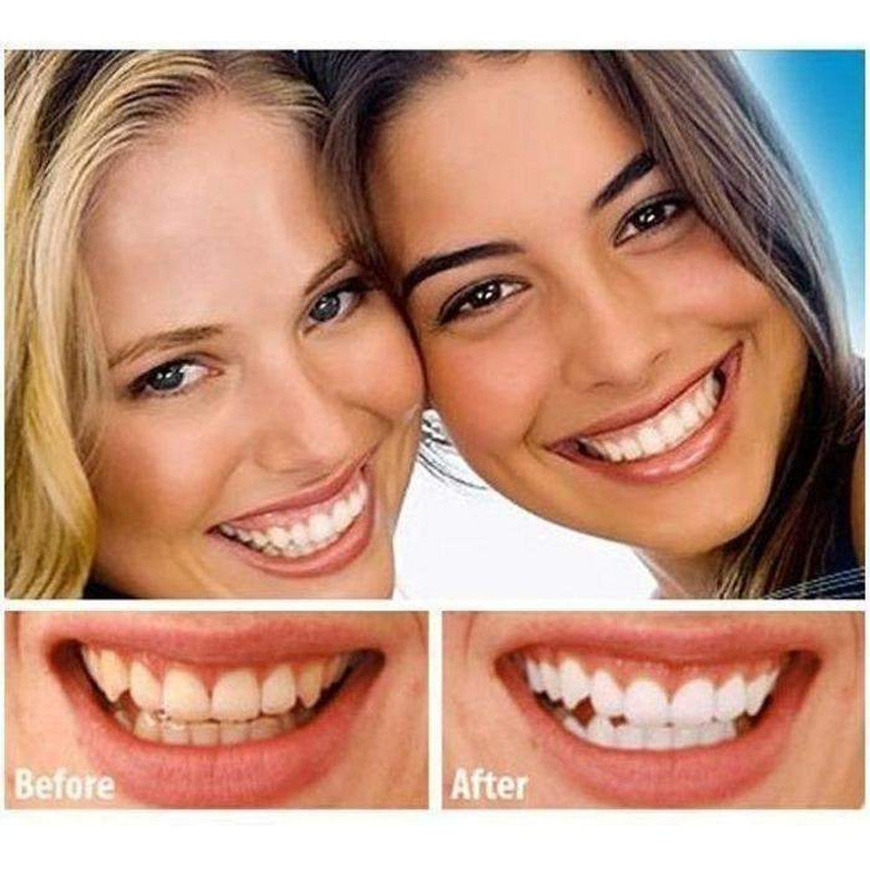White Light Teeth Whitening System – Elevation